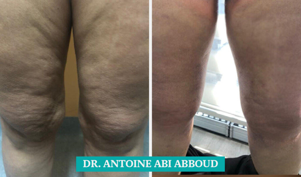 Thigh lift surgery | SILKOR UAE