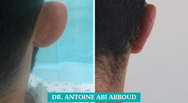 Otoplasty Surgery to Enhance Ear Appearance | SILKOR UAE