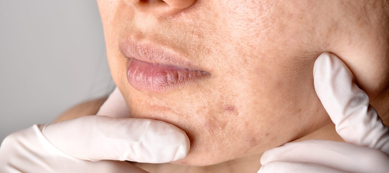 Acne Scars Treatments Silkor Uae