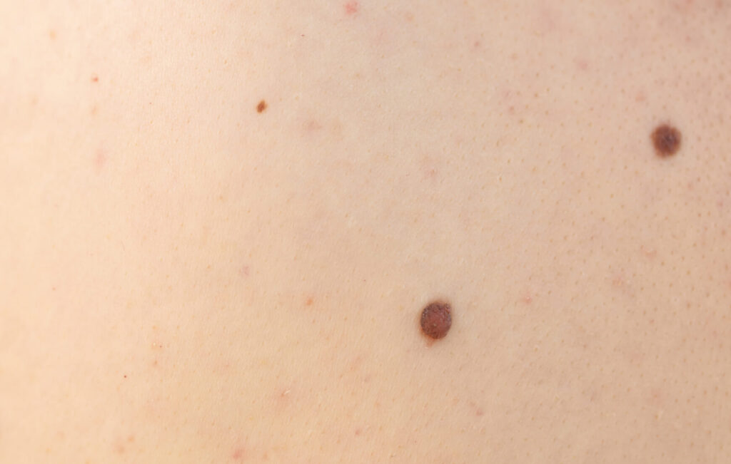 Moles Causes and Solutions | SILKOR UAE