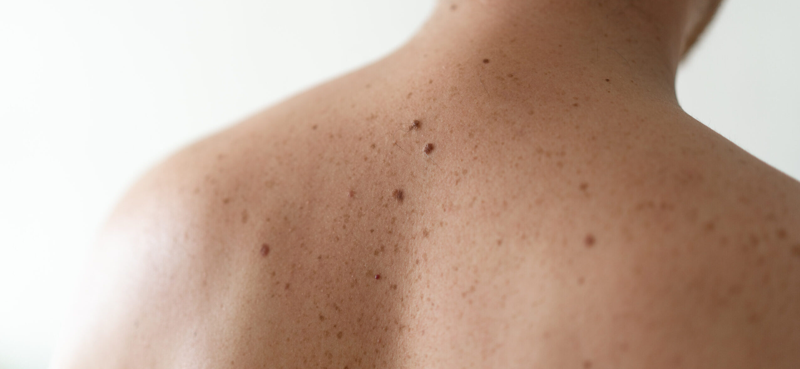 Moles Moles