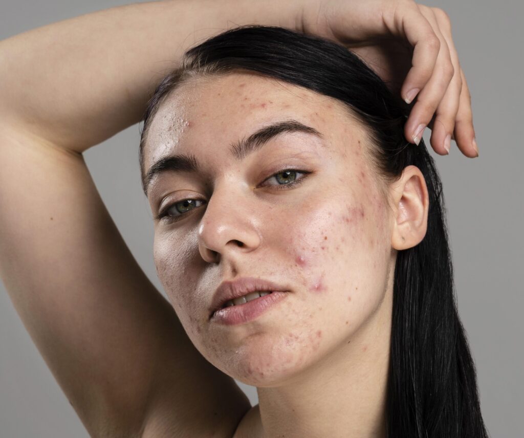 Acne Causes and Treatments | SILKOR UAE