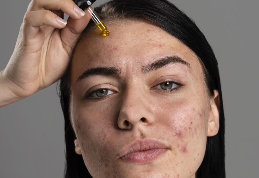 Acne Causes and Treatments | SILKOR UAE